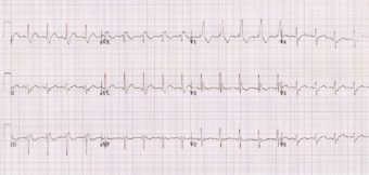 Bifascicular Block • LITFL • ECG Library Diagnosis