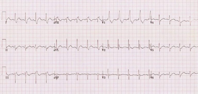 Masquerading Bundle Branch Block (MBBB) • LITFL • ECG Library