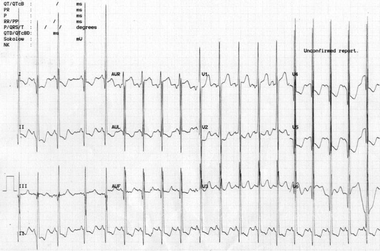 Biventricular Hypertrophy • LITFL • ECG Library Diagnosis