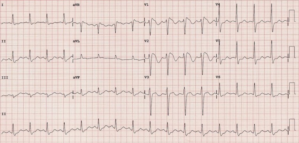 Brugada Syndrome • LITFL • ECG Library Diagnosis