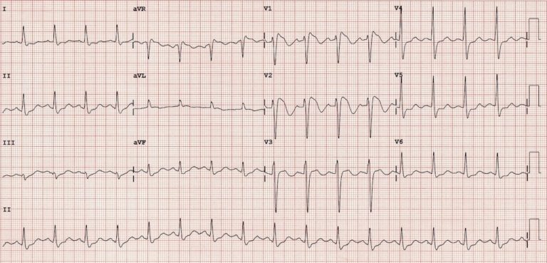 Brugada Syndrome • LITFL • ECG Library Diagnosis