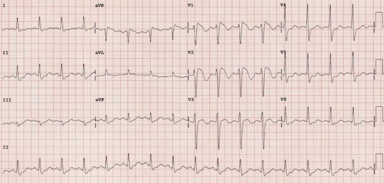 Right Bundle Branch Block (RBBB) • LITFL • ECG Library Diagnosis