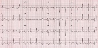 Brugada Syndrome • LITFL • ECG Library Diagnosis