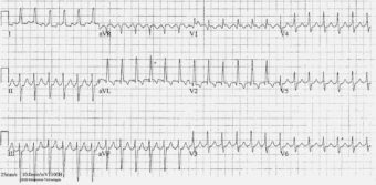 ECG Case 018 • LITFL • ECG Top 100 Self-Assessment Quiz