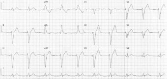 Killer ECG Patterns: Part 2 • LITFL • ECG Library