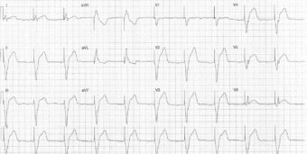 Killer ECG Patterns: Part 2 • LITFL • ECG Library
