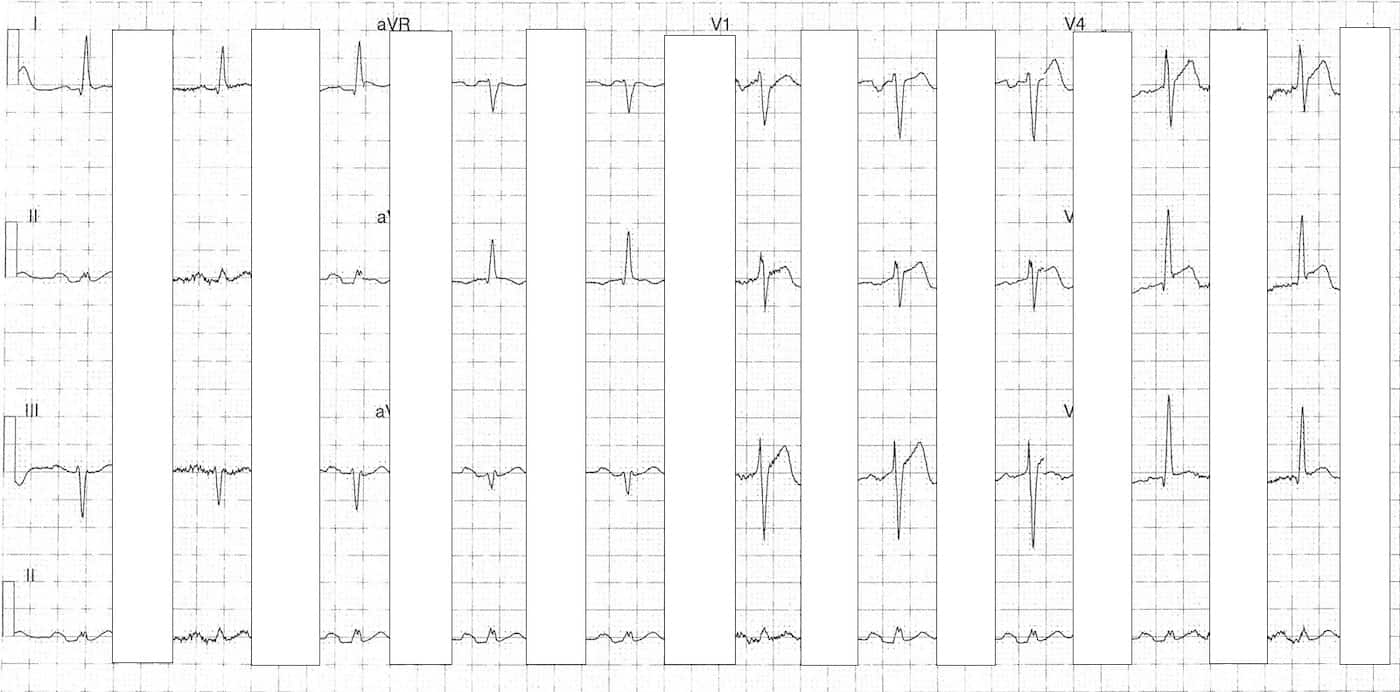 ECG Case 089 • LITFL • ECG Top 100 Self-Assessment Quiz