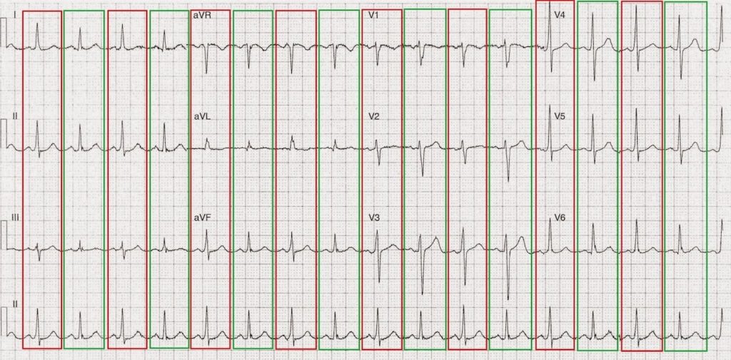 ECG Case 097 • LITFL • ECG Top 100 Self-Assessment Quiz