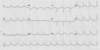 The ST Segment • LITFL • ECG Library Basics