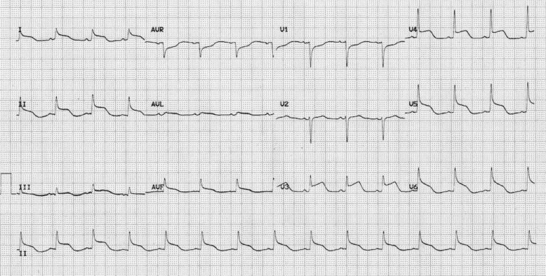 The ST Segment • LITFL • ECG Library Basics
