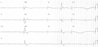 Ventricular Escape Rhythm • LITFL • ECG Library Diagnosis