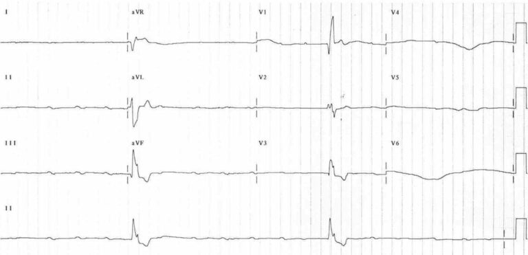 AV block: 3rd degree (complete heart block) • LITFL • ECG Library