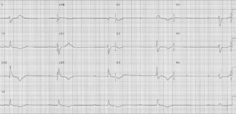 AV block: 3rd degree (complete heart block) • LITFL • ECG Library
