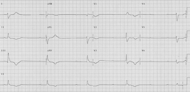 AV block: 3rd degree (complete heart block) • LITFL • ECG Library