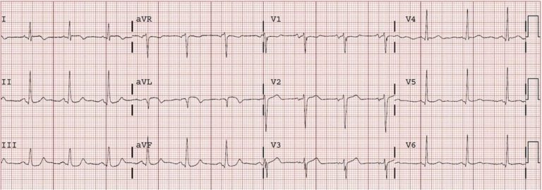 Lateral STEMI ECG changes • LITFL • ECG Library Diagnosis