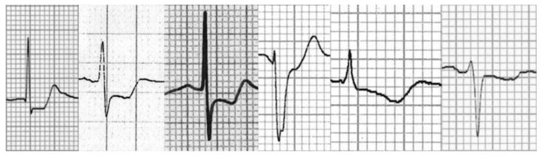 The ST Segment • LITFL • ECG Library Basics