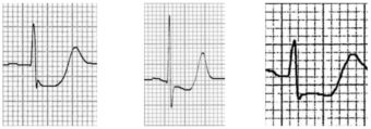 The ST Segment • LITFL • ECG Library Basics