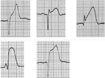 The ST Segment • LITFL • ECG Library Basics