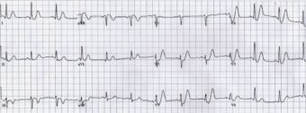 De Winter T Wave • LITFL • ECG Library Diagnosis