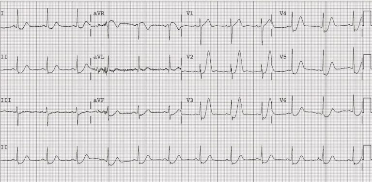 Killer ECG Patterns: Part 2 • LITFL • ECG Library