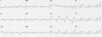 Killer ECG Patterns: Part 2 • LITFL • ECG Library