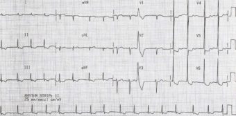 QT Interval • LITFL • ECG Library Basics