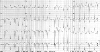 Dilated Cardiomyopathy (DCM) • LITFL • ECG Library Diagnosis