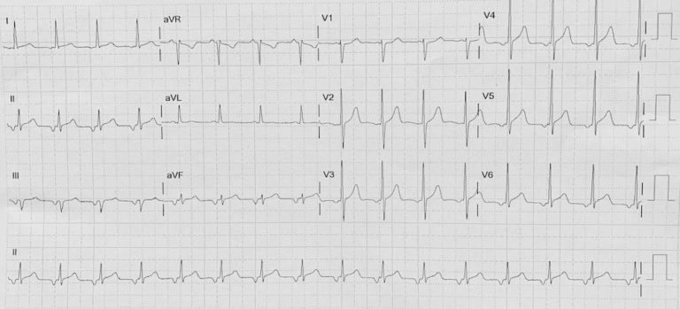 Focal Atrial Tachycardia (FAT) • LITFL • ECG Library Diagnosis