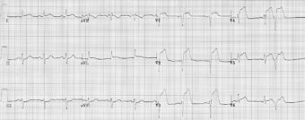 Anterior Myocardial Infarction • LITFL • ECG Library Diagnosis