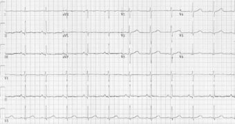 Supraventricular Tachycardia (SVT) • LITFL • ECG Library Diagnosis