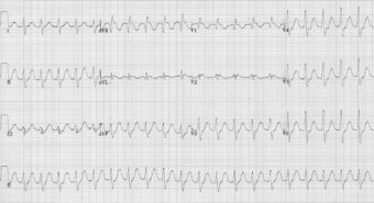 Tricyclic Overdose • LITFL • ECG Library