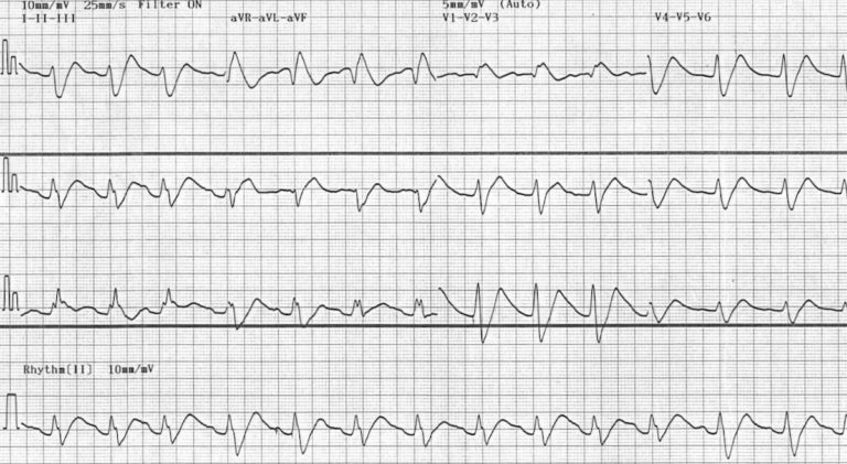 Tricyclic Overdose • LITFL • ECG Library