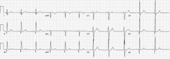 Hypertrophic Cardiomyopathy (HCM) • LITFL • ECG Library Diagnosis