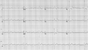 AV block: 2nd degree, “high-grade” AV block • LITFL • ECG Library