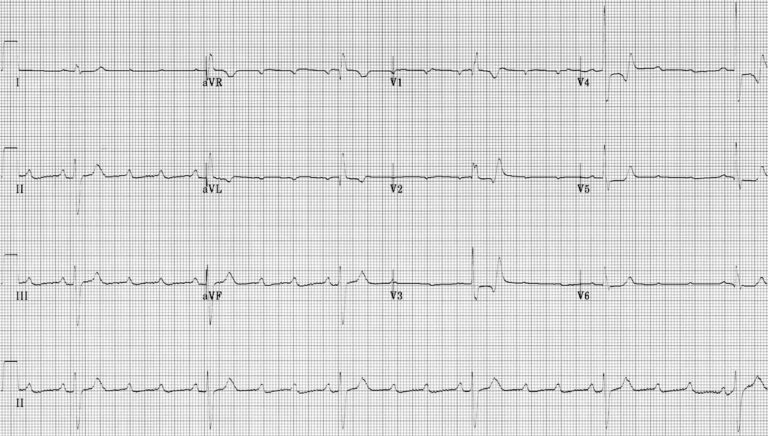 AV block: 2nd degree, “high-grade” AV block • LITFL • ECG Library