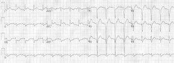 High Lateral STEMI • LITFL • ECG Library Diagnosis