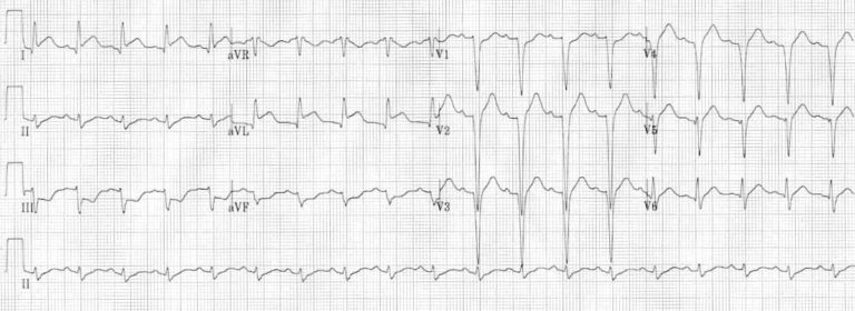 High Lateral STEMI • LITFL • ECG Library Diagnosis
