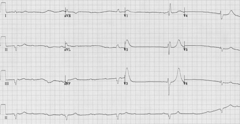 Beta-blocker and Calcium-channel blocker toxicity • LITFL • ECG Library Beta-blocker and Calcium-channel blocker toxicity • LITFL • ECG Library