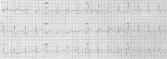 High Lateral STEMI • LITFL • ECG Library Diagnosis