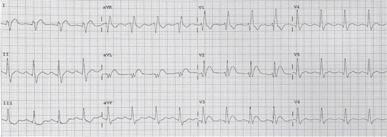 High Lateral STEMI • LITFL • ECG Library Diagnosis