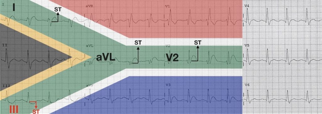 High Lateral STEMI • LITFL • ECG Library Diagnosis