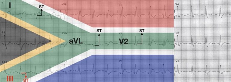 High Lateral STEMI • LITFL • ECG Library Diagnosis