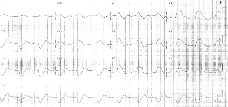 Hyperkalaemia ECG changes • LITFL • ECG Library