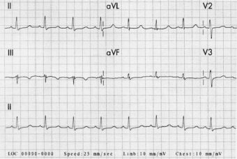 Hypocalcaemia ECG changes • LITFL • ECG Library