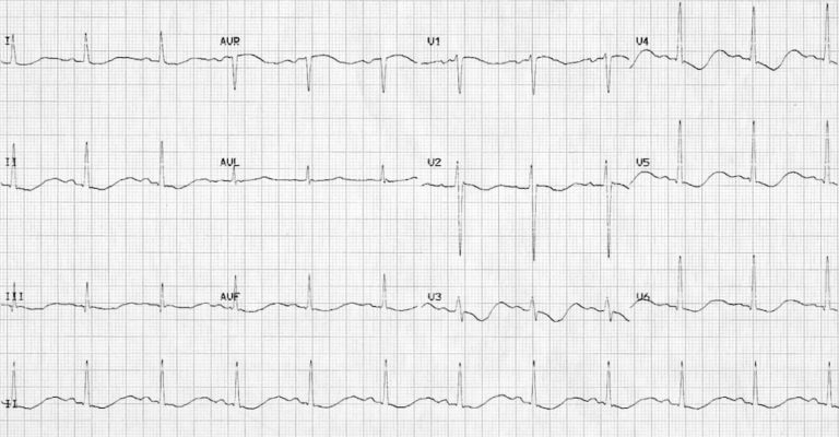 The ST Segment • LITFL • ECG Library Basics