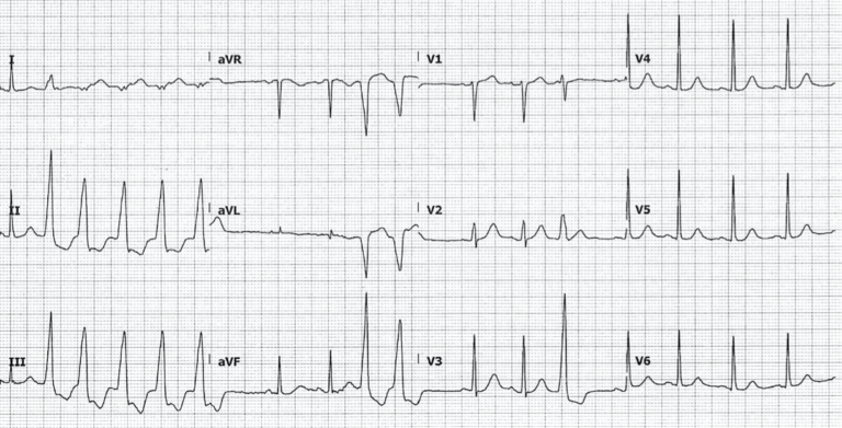 Hypomagnesaemia ECG changes • LITFL • ECG Library Hypomagnesaemia ECG changes • LITFL • ECG Library
