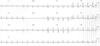 Hypomagnesaemia ECG changes • LITFL • ECG Library