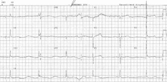 Hypothermia ECG changes • LITFL • ECG Library Diagnosis