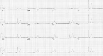 Hypothermia ECG changes • LITFL • ECG Library Diagnosis