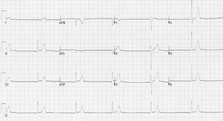 Hypothermia ECG changes • LITFL • ECG Library Diagnosis